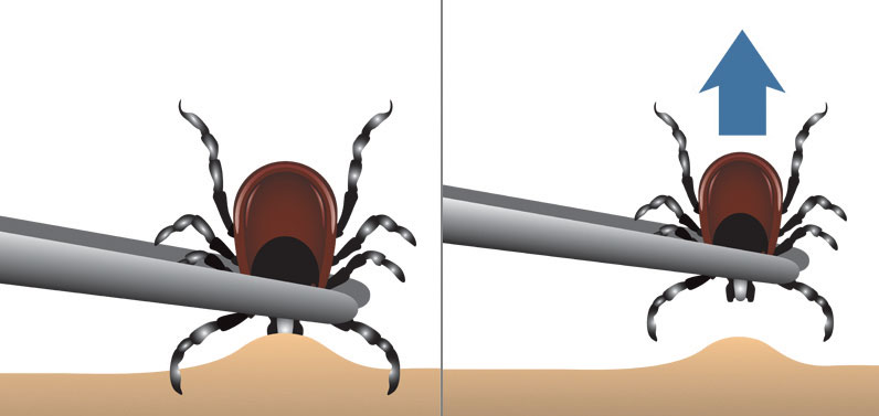 Best Way To Safely Remove Ticks From A Human Tick Removal